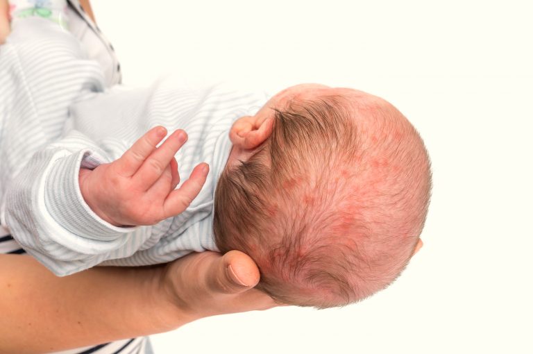Granitos con pus en la piel del bebé: ¿Por qué le salen nacidos a los ...